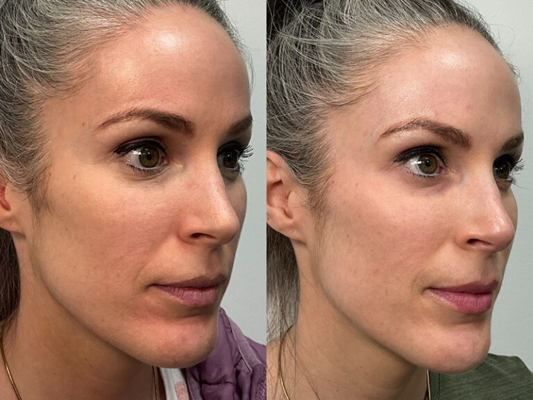 Skinbooster Treatments in Dallas - CULT Aesthetics